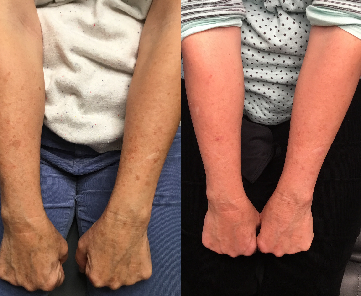 BBL Photofacial 6 - Touch MedSpa