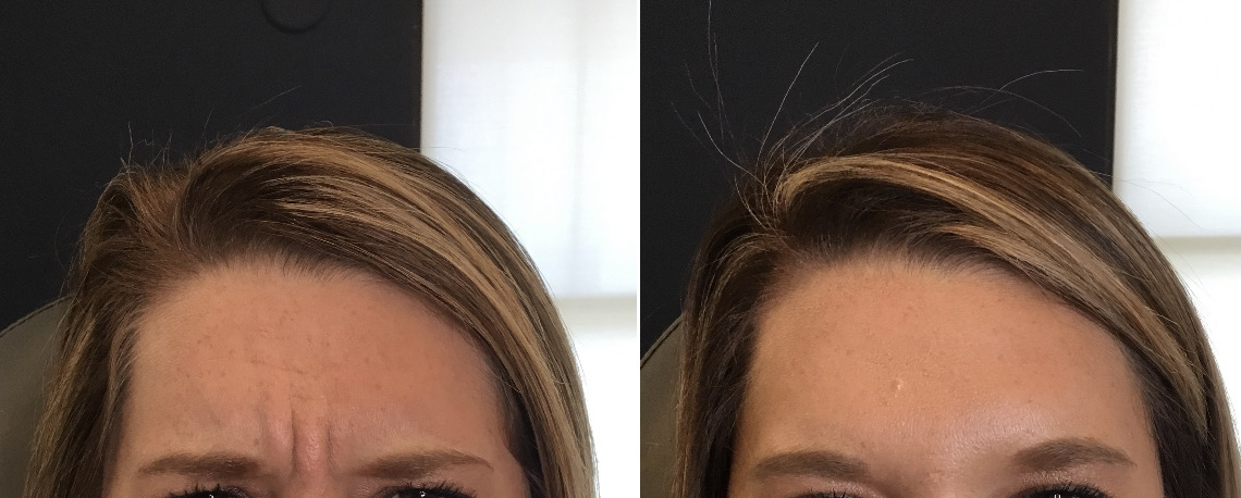 Botox 14 - Touch MedSpa