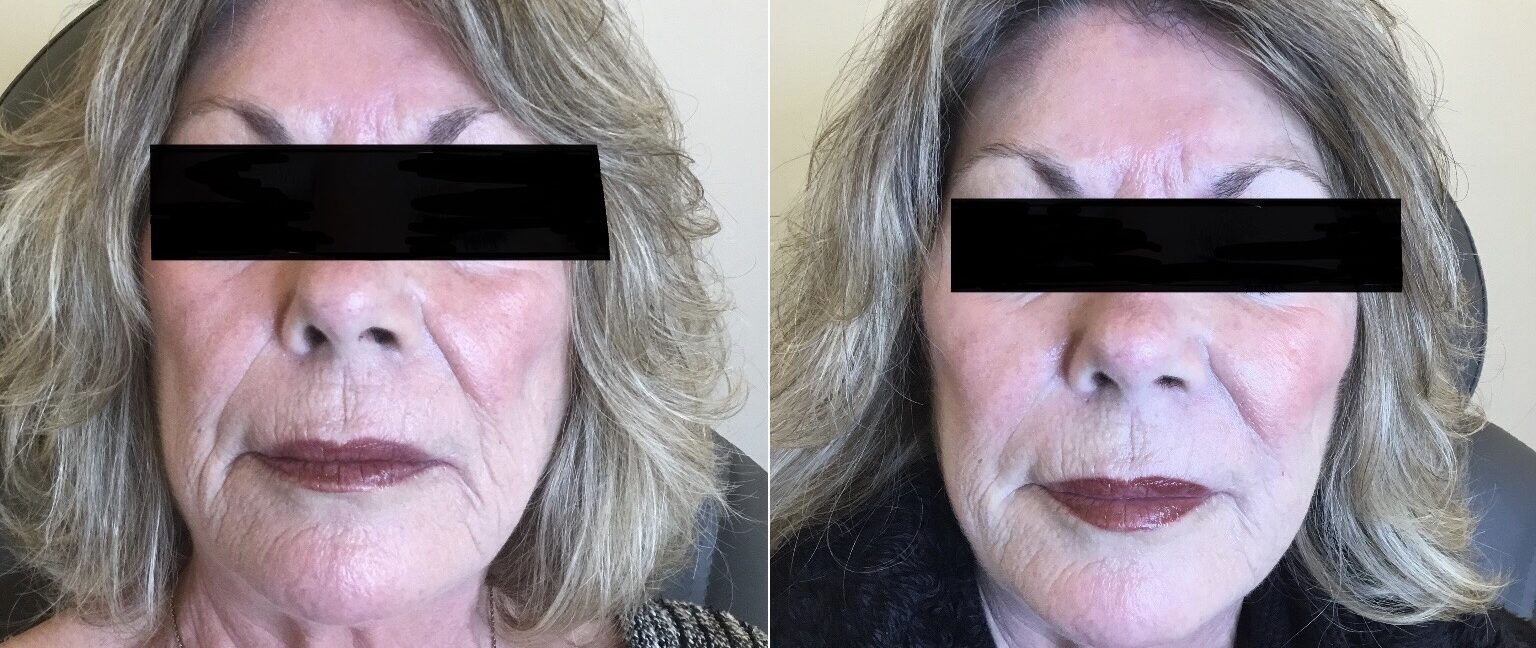 Dermal Fillers 7 - Touch MedSpa