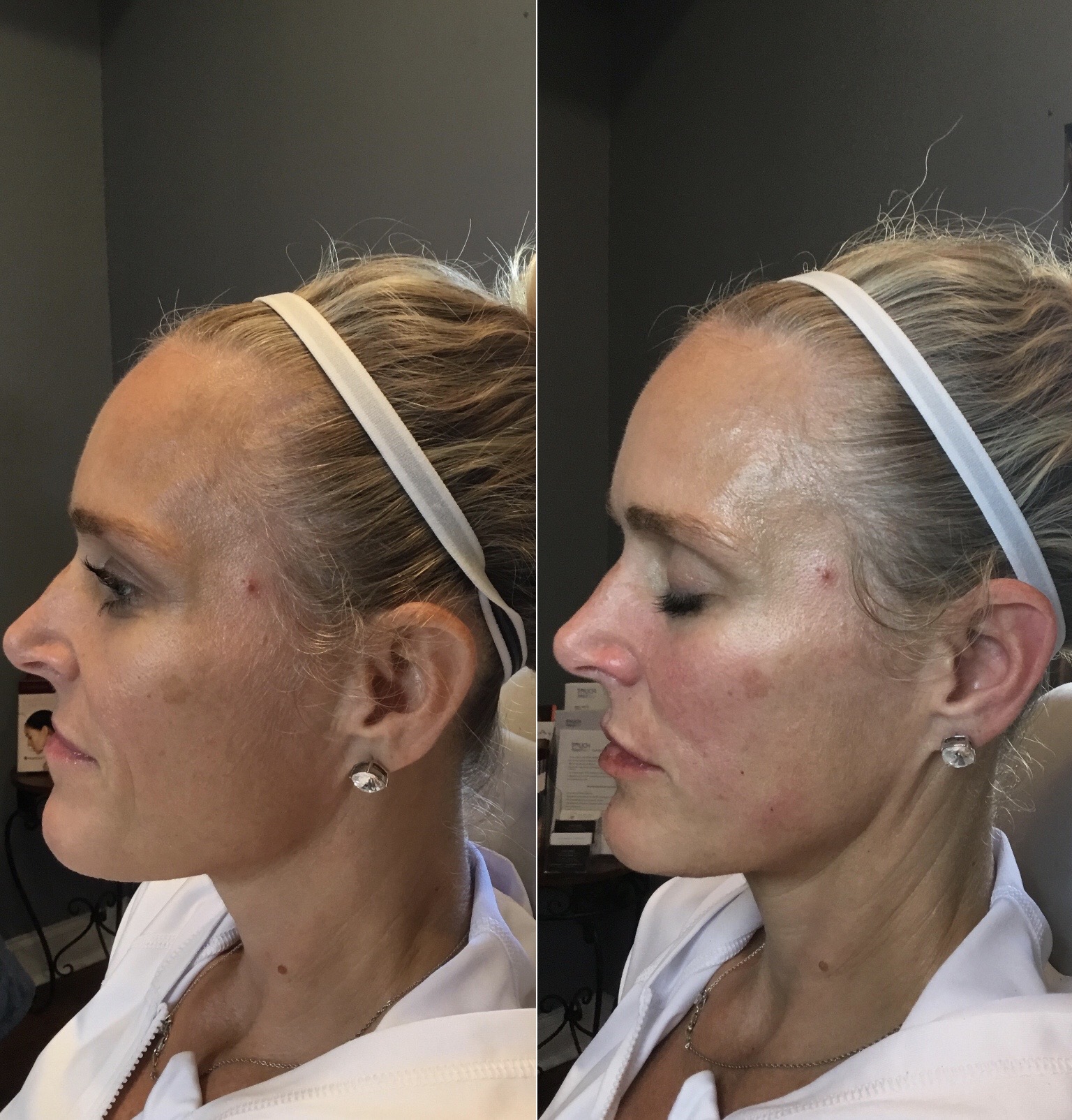 Dermal Fillers 9 - Touch MedSpa