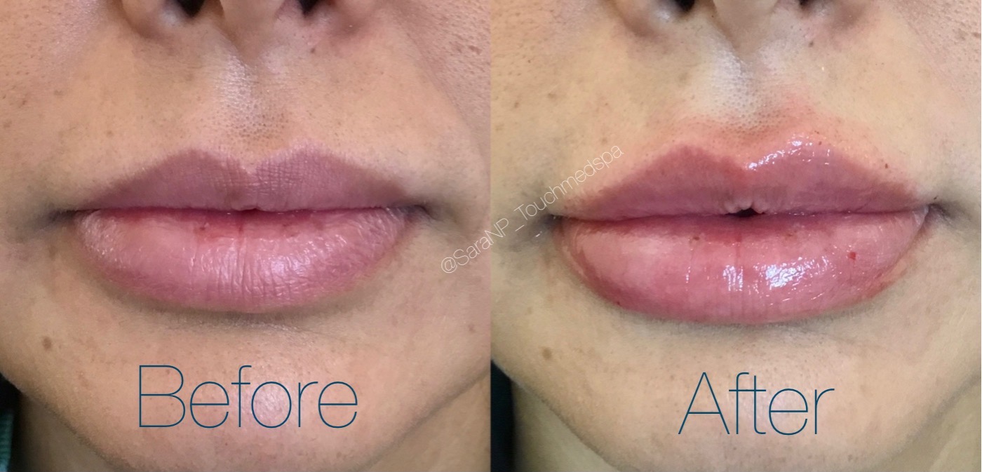 Lip Filler 11 - Touch MedSpa