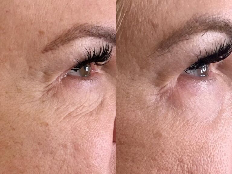 Plasma Pen in North Myrtle Beach | Touch MedSpa