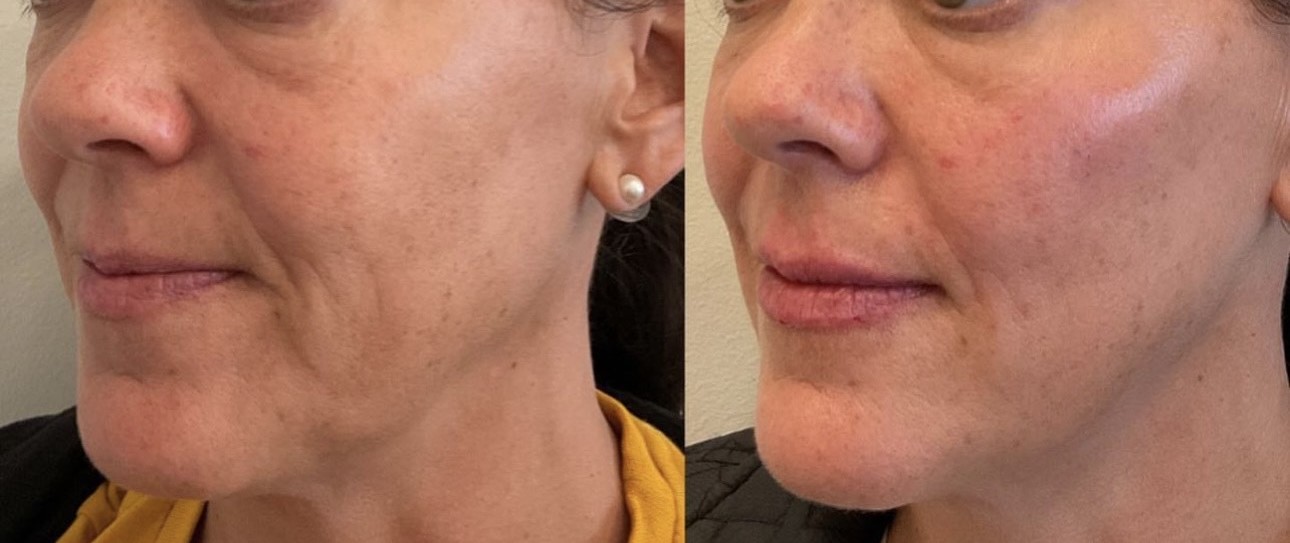 Dermal Fillers 13 - Touch MedSpa