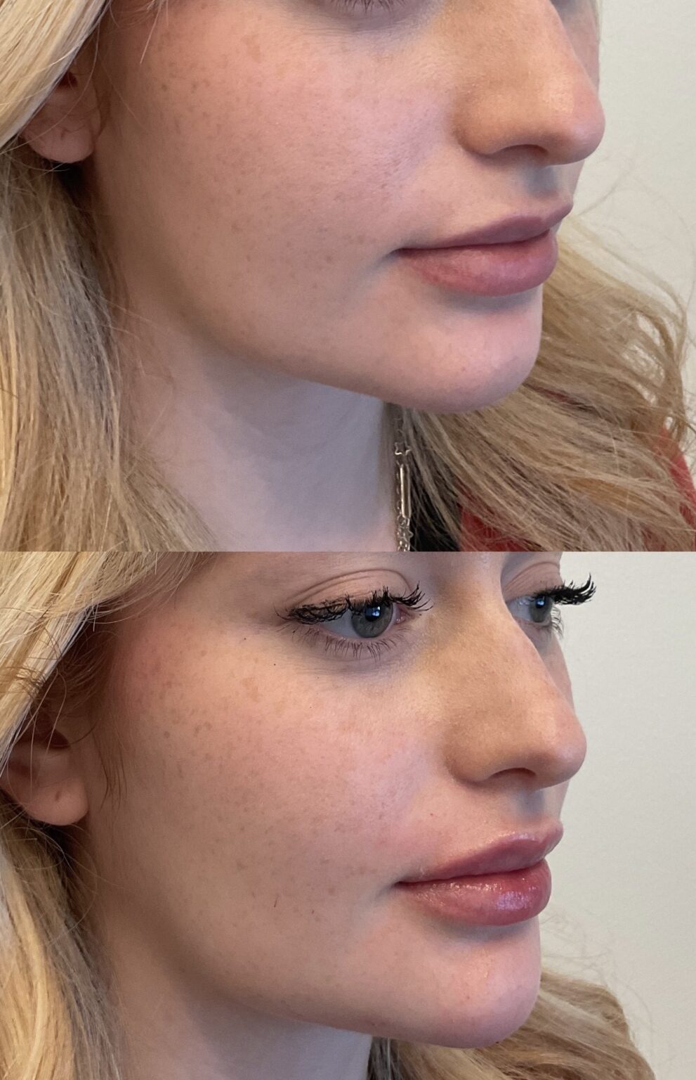 Dermal Fillers 11 - Touch MedSpa