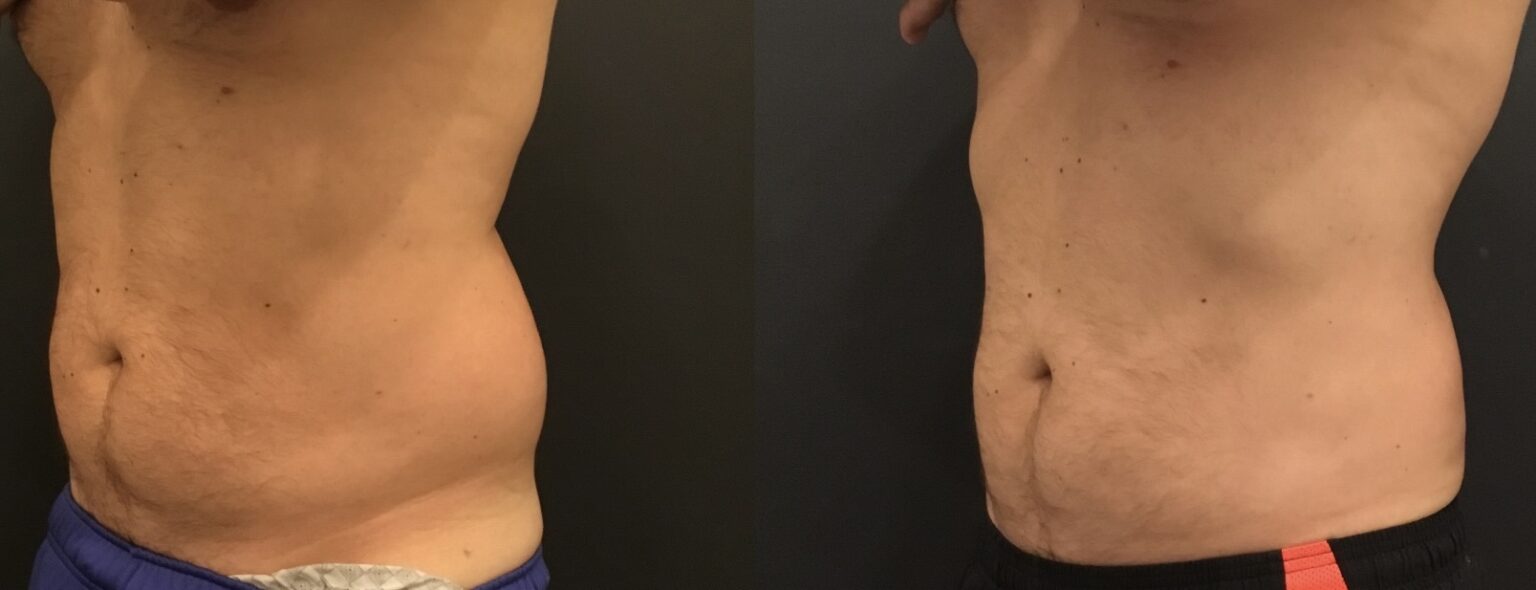 Coolsculpting Flanks 2 - Touch MedSpa